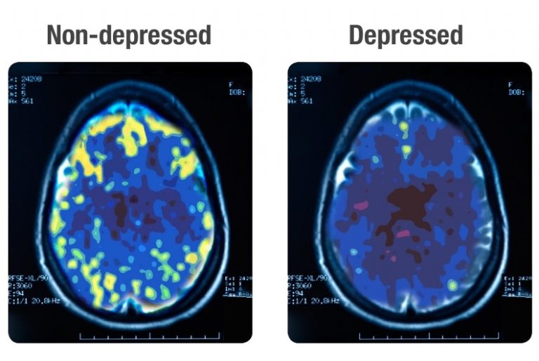 depressed-brain-images | Michael Frampton, M.D. & Associates